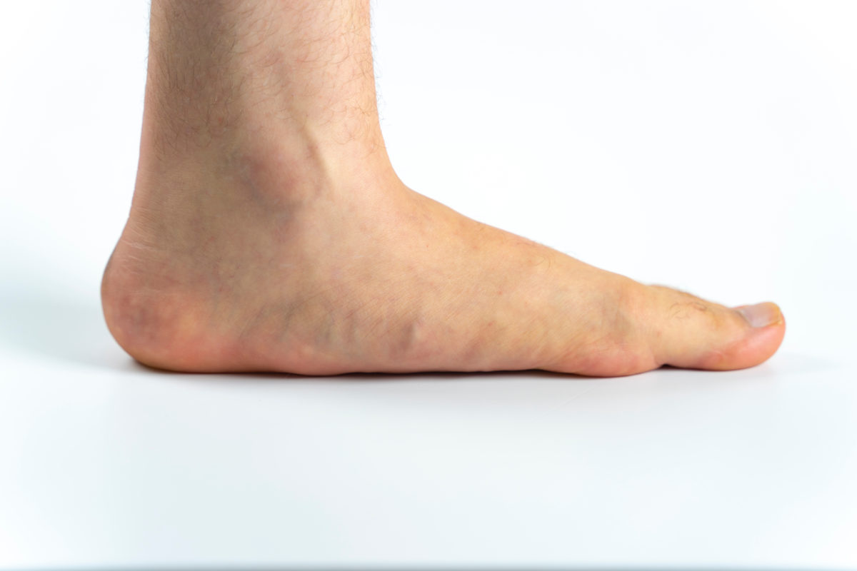Common Flatfoot Deformities that May Require Surgery