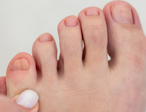 Common Flatfoot Deformities that May Require Surgery