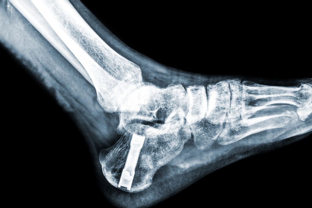 Life After a Calcaneus Fracture: Steps to Recovery