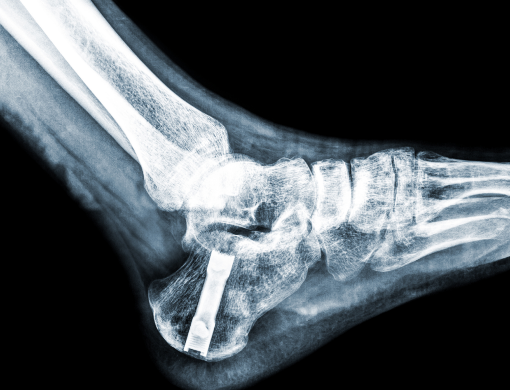 Signs That You Have Dislocated Your Foot: Is Surgery Required?